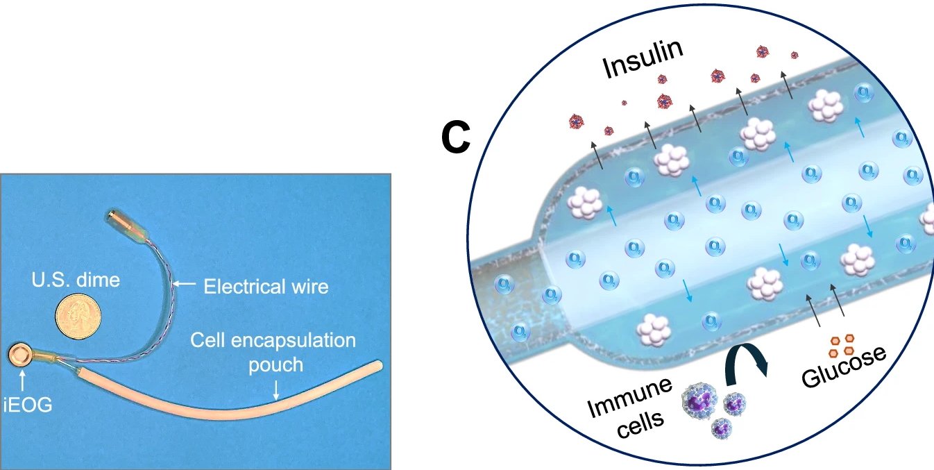 Oxygen-Generating Implant Offers New Hope for Type 1 Diabetes Treatment ...