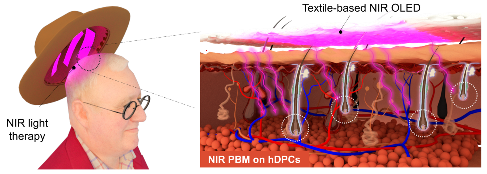 Textile-Based OLED Cap Suppresses Hair Follicle Aging for Noninvasive ...